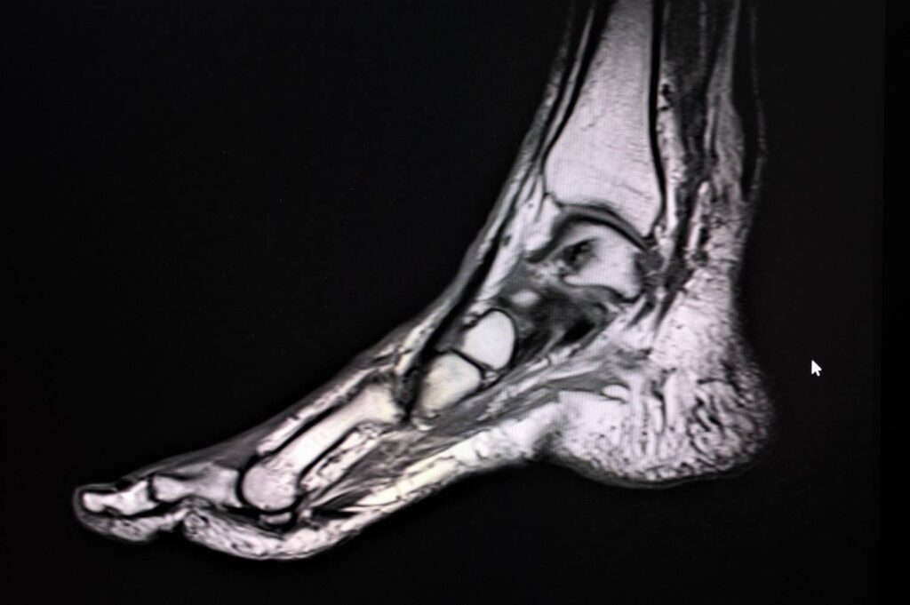 MRT Zehen | Beyond Imaging