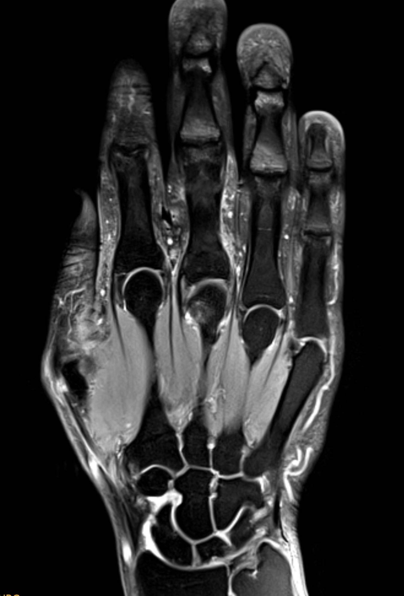 MRT Hand | Beyond Imaging